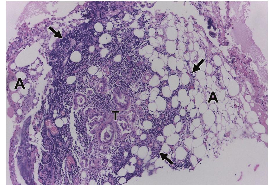 Metastatic adenocarcinoma in extrapleural adi- pose tissue.