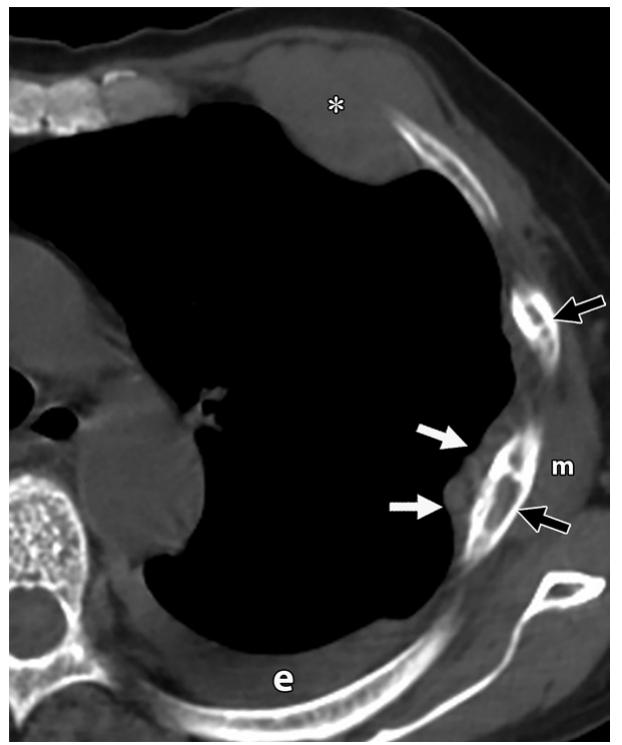 Multiple myeloma. axial cropped ct image shows a large soft-