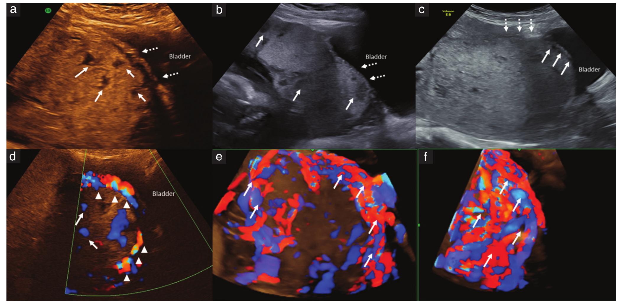 Sonographic signs of morbidly adherent placenta (map) on