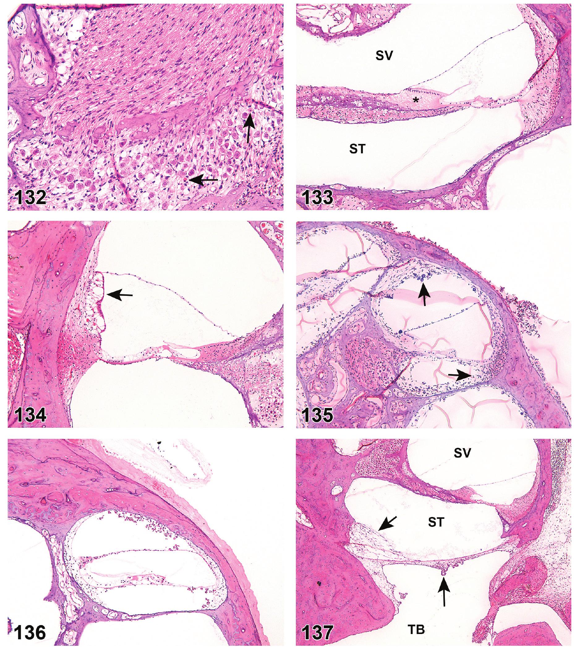Figure 25 - Nonproliferative and Proliferative Lesions of