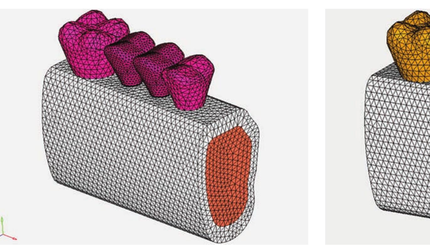 Meshed model of implant and bone assembly for crestal