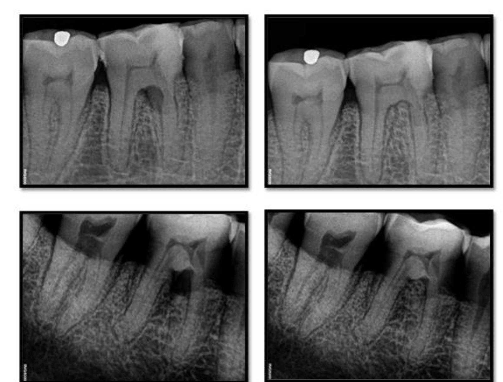 Figure 4 - from Management of Grade II Furcation Defect in