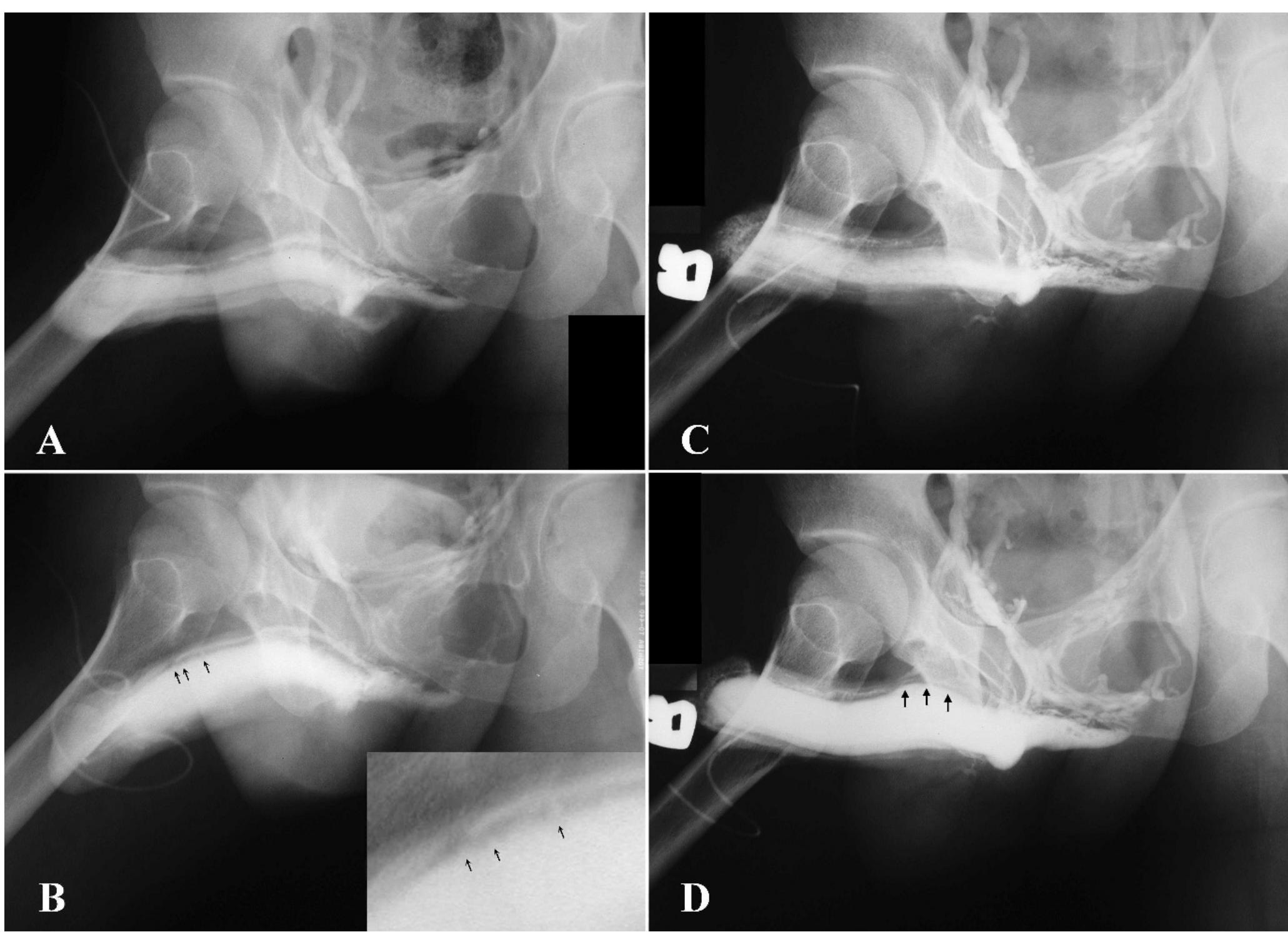 Cavernosograms of a crateriform tunical defect in a