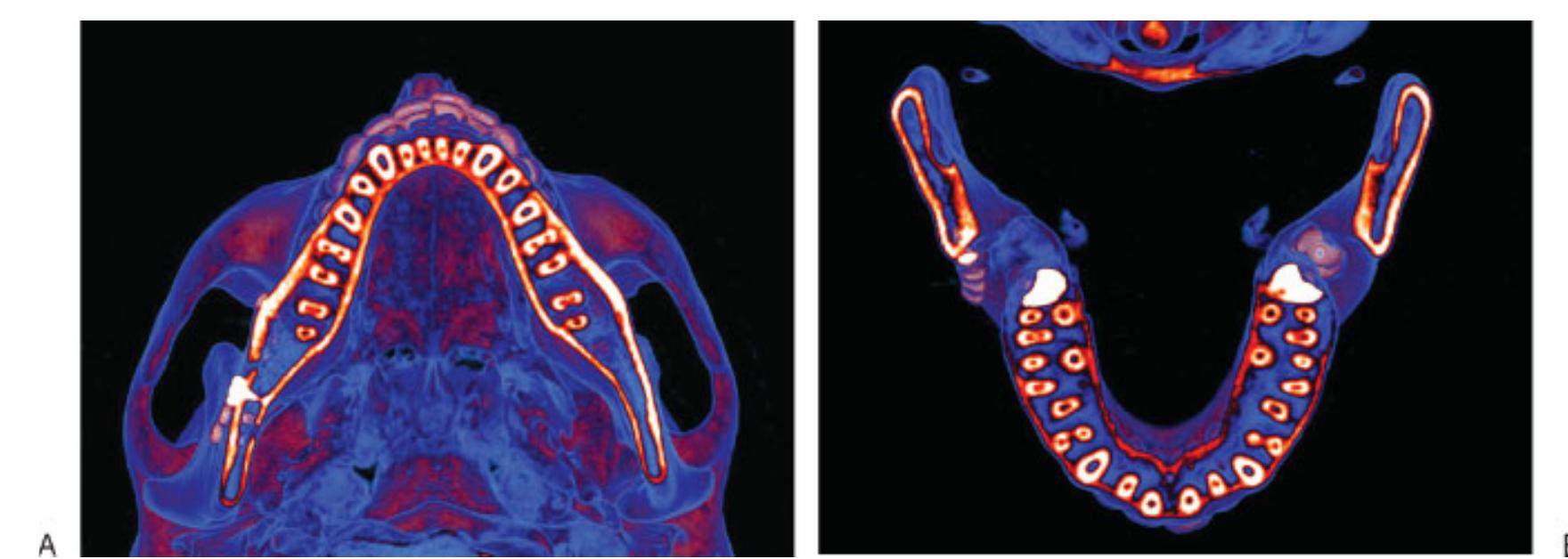 Colored ct scans highlighting the (a) mandibular and (b)