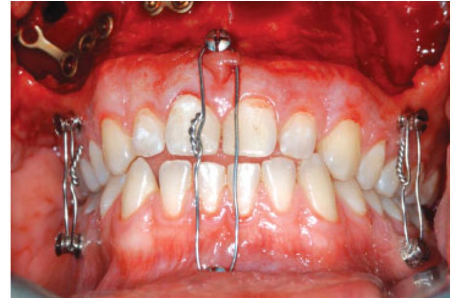 Anterior open bite deformity and le fort | fracture (exposed
