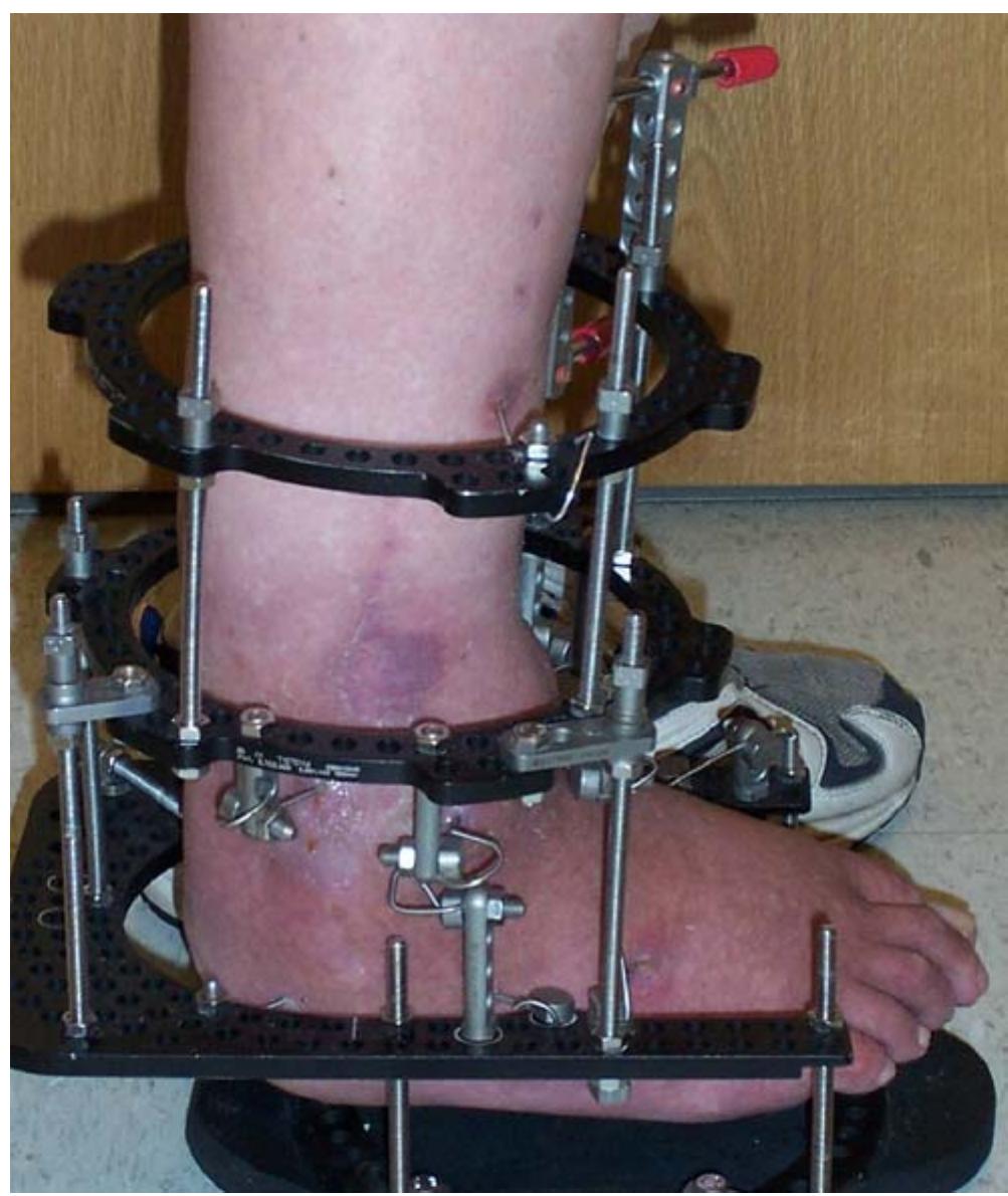 This ankle fusion frame combines the classic ilizarov