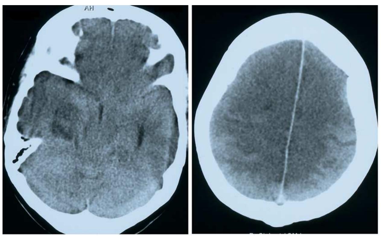 Ct scan of a severely head-injured patient with diffuse