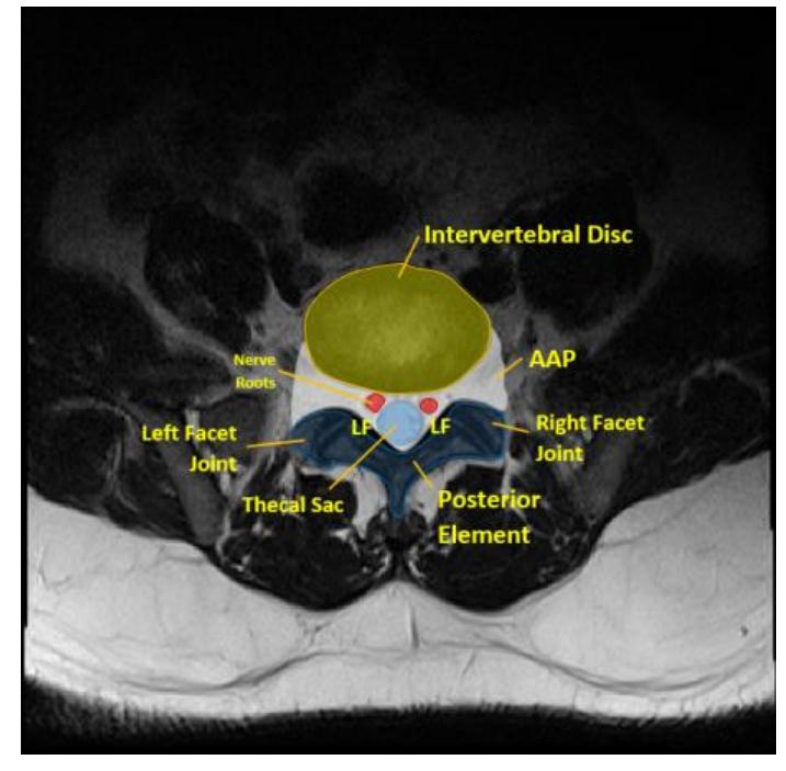 Axial view mri of d4 fig. 1. sagittal view mri of a lumbar