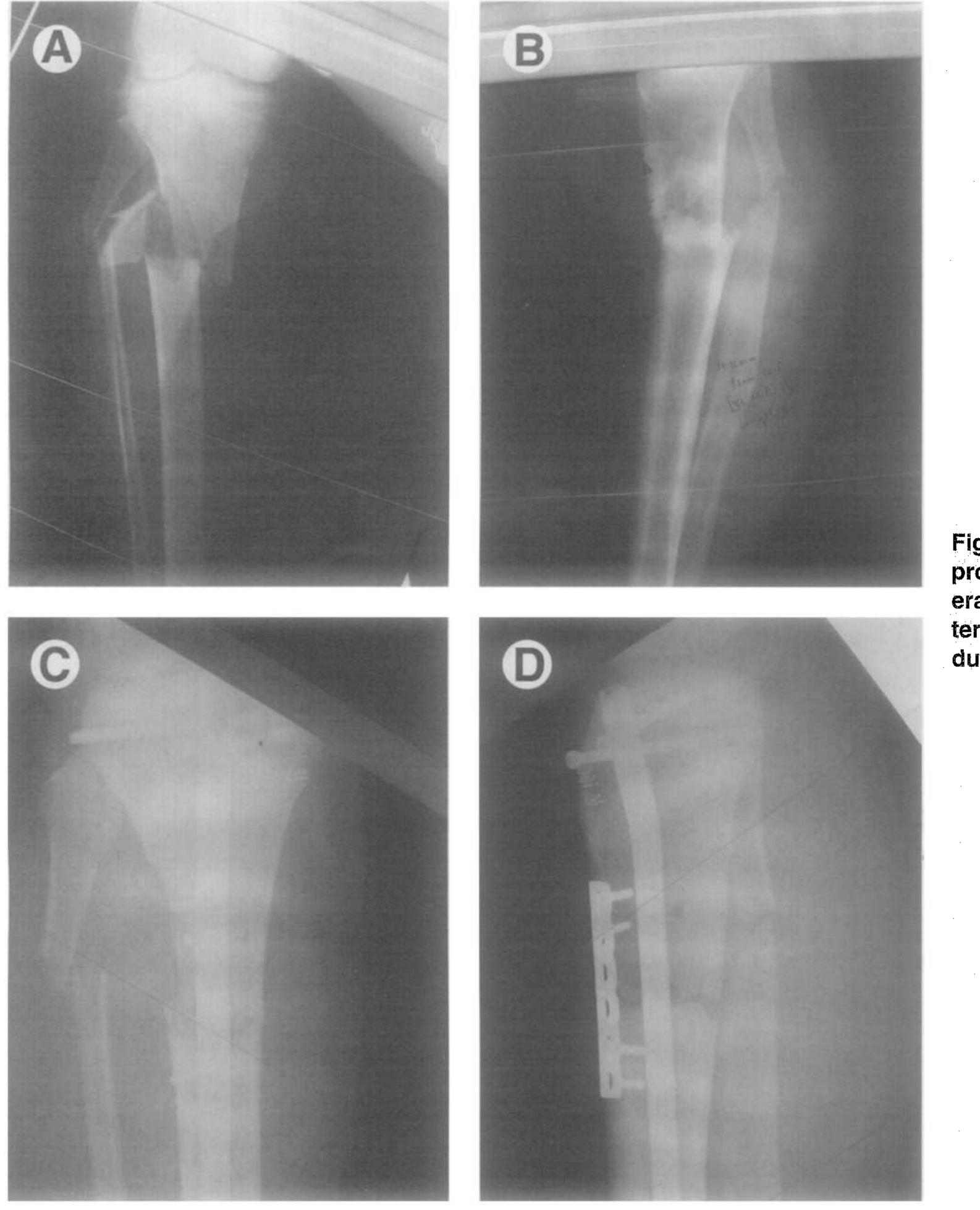 Deformity of the proximal segment and helps maintain the