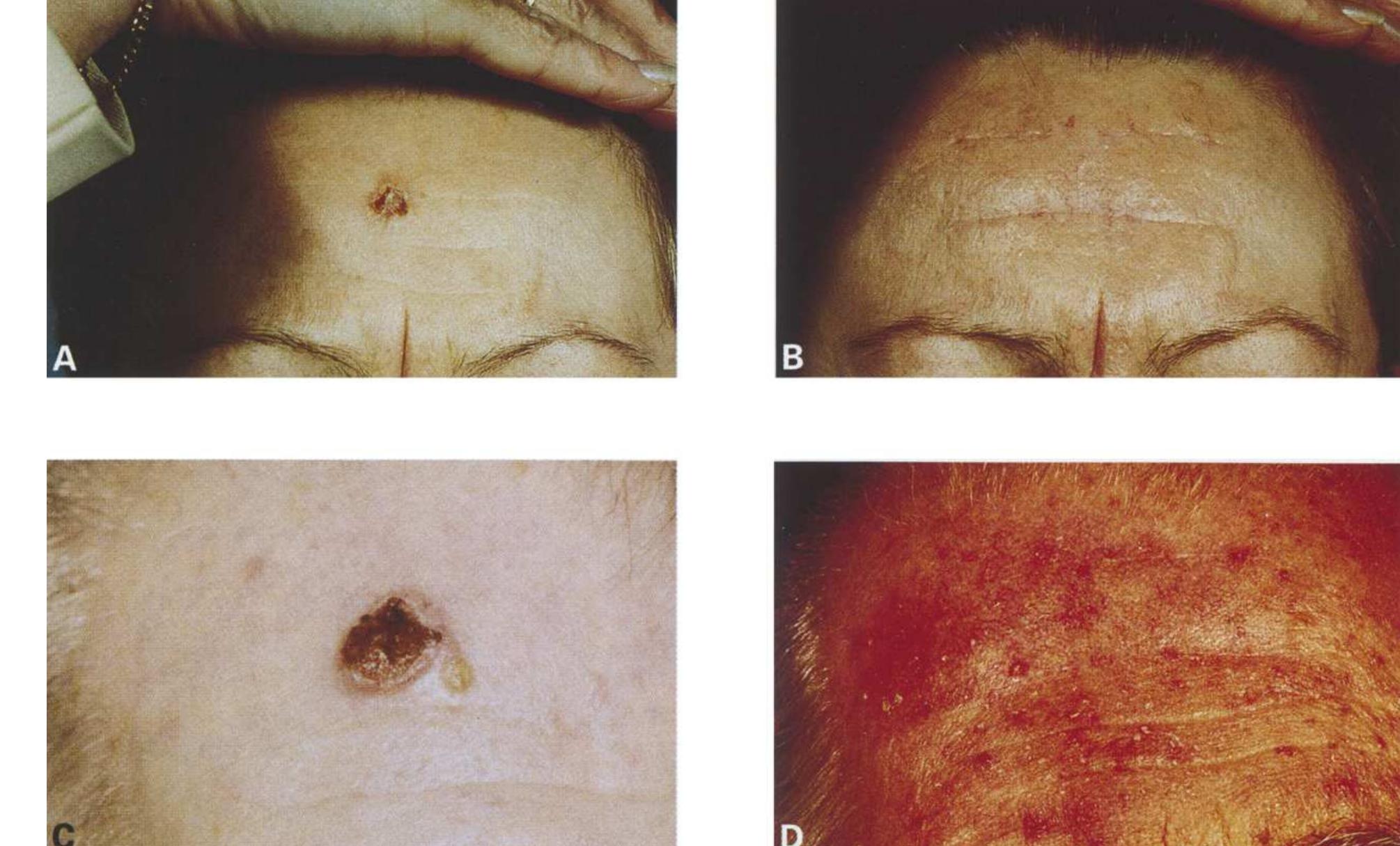 Figure 3 - from The H-flap: a useful flap for forehead