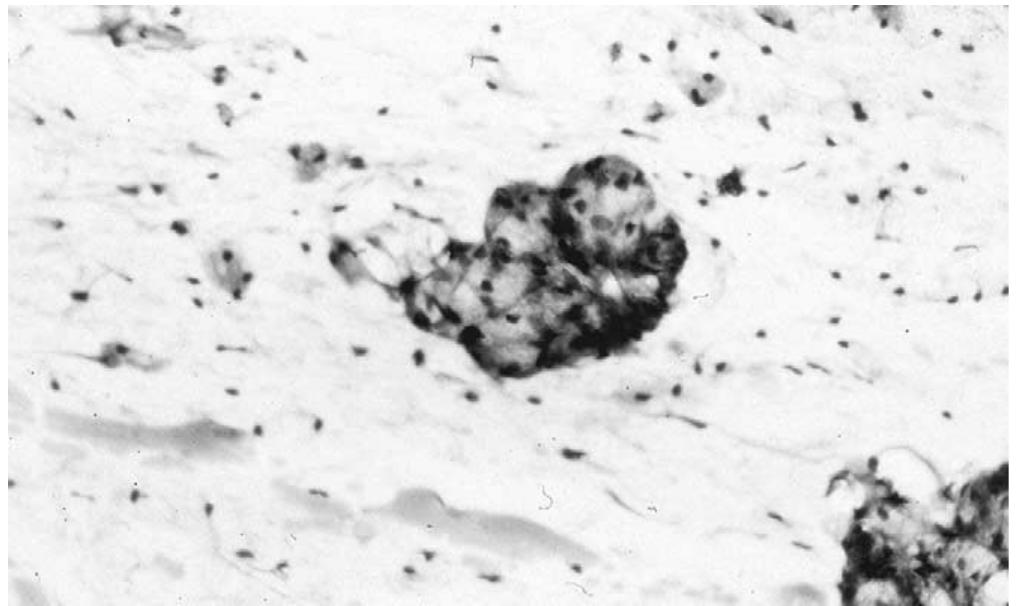 Aspirate of a submandibular salivary gland. a cluster of