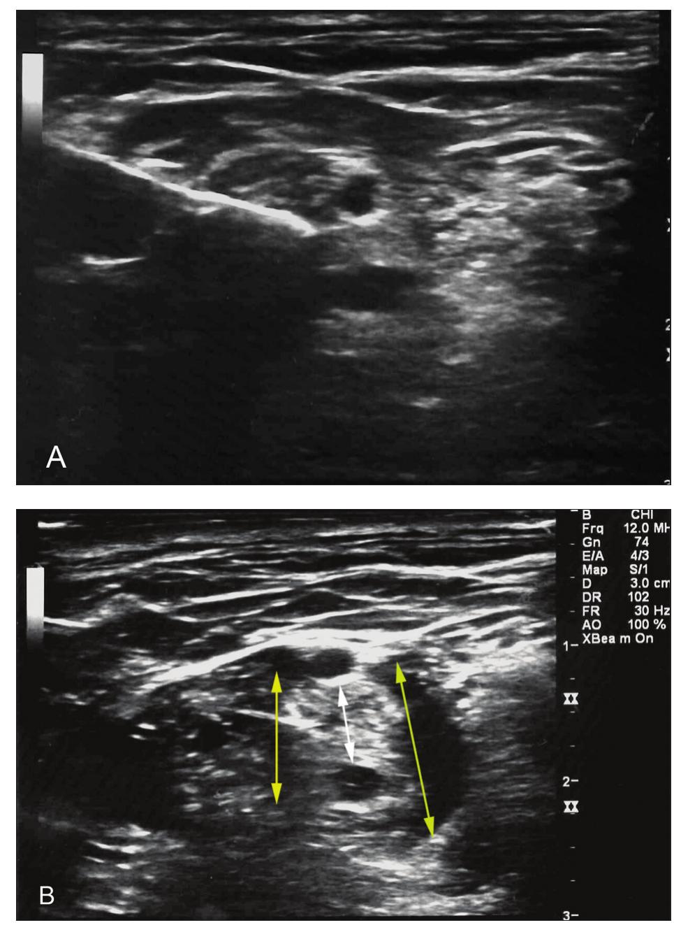Local anesthetic spread pattern for injections inside the