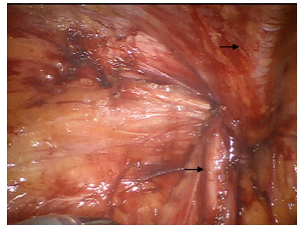 Illustration of inguinal dissection. notes: top arrow shows