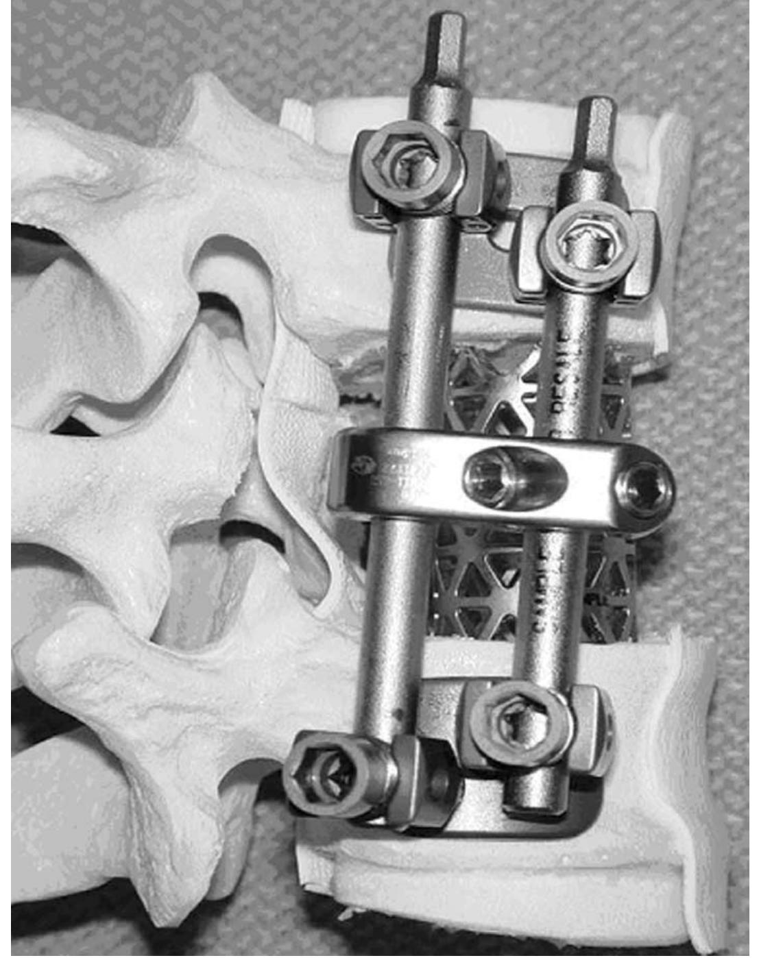 The antares dual-rod anterior fixation system. a thoracotomy