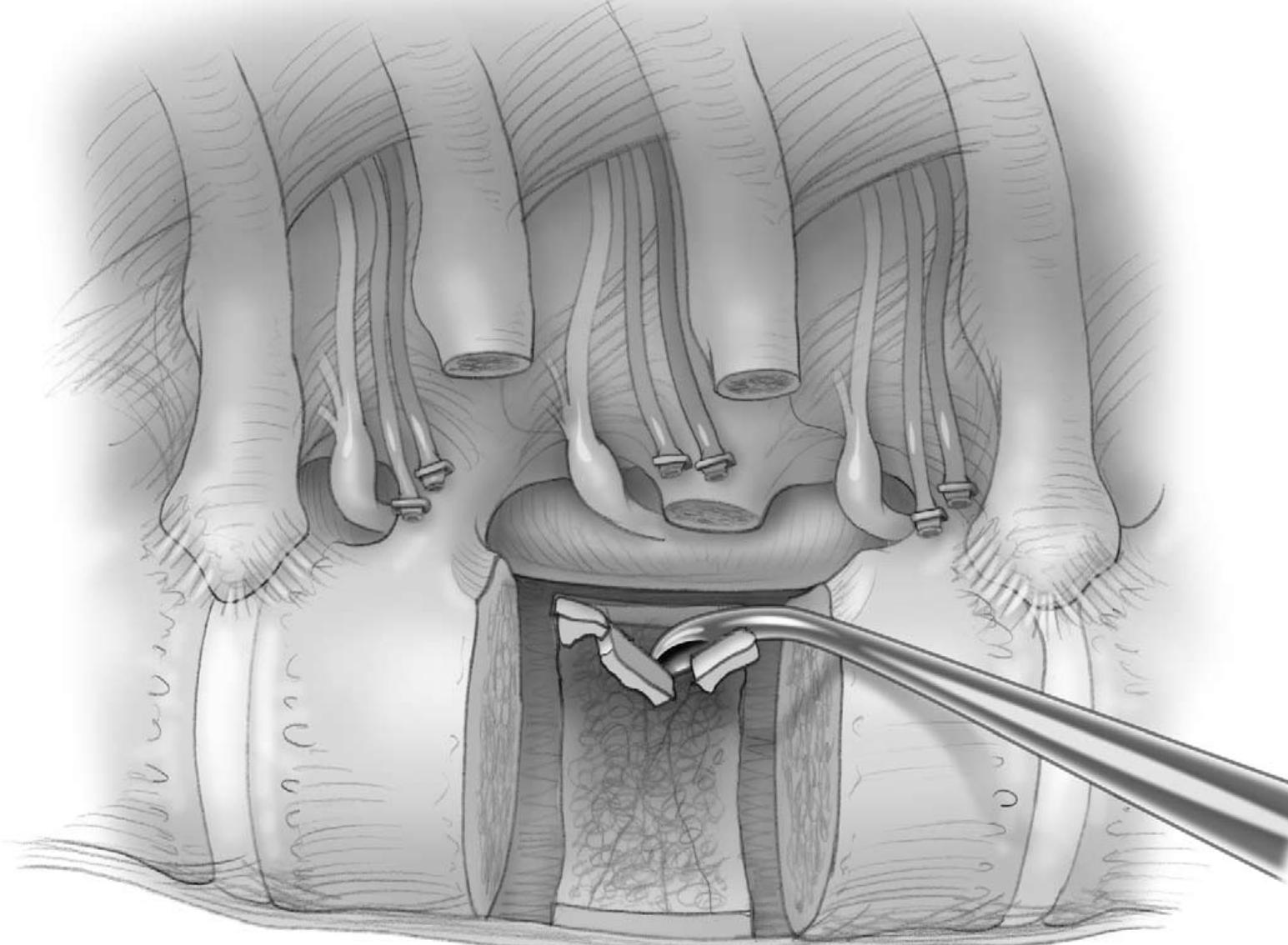 The lateral aspect of the vertebral body is prepared by