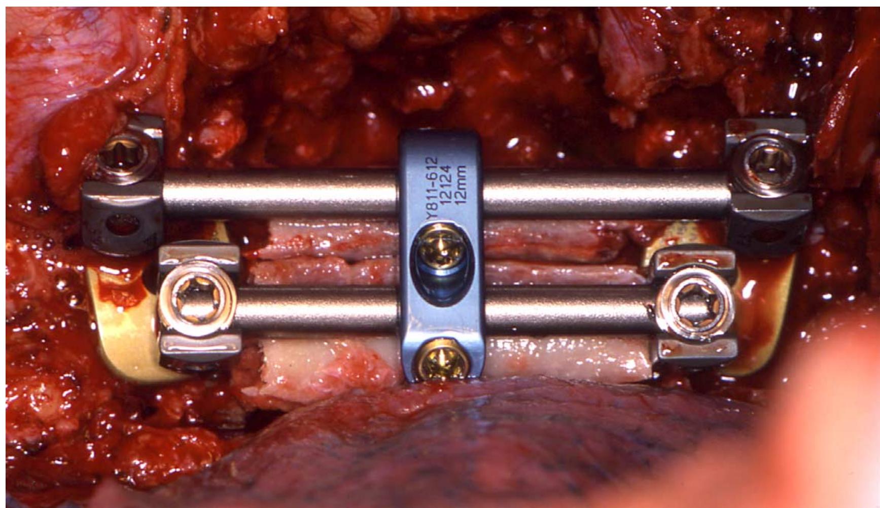 Intraoperative photograph showing femur allograft ring