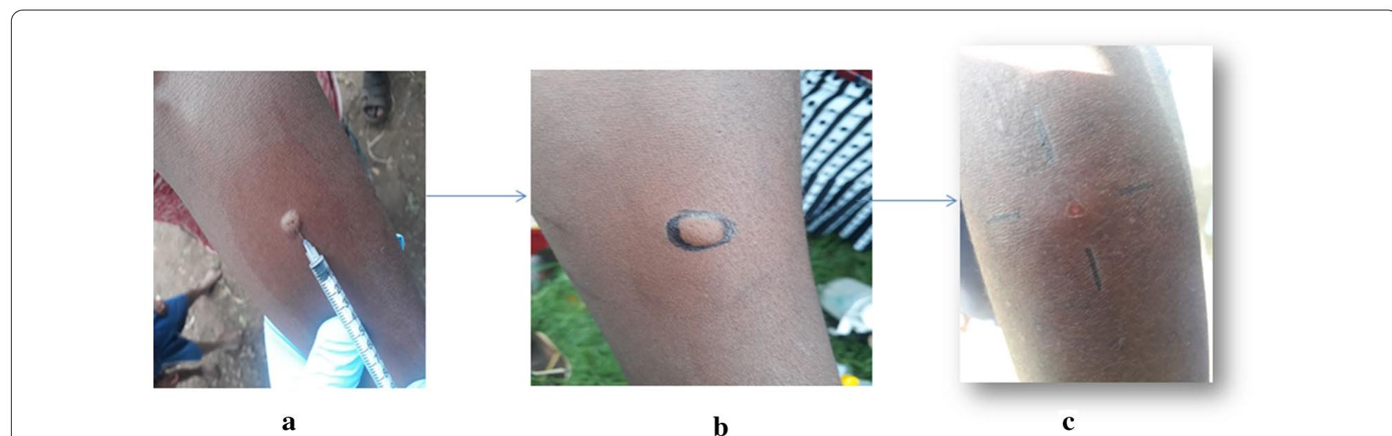 Leishmanin skin test (lst) procedure. photos are from this