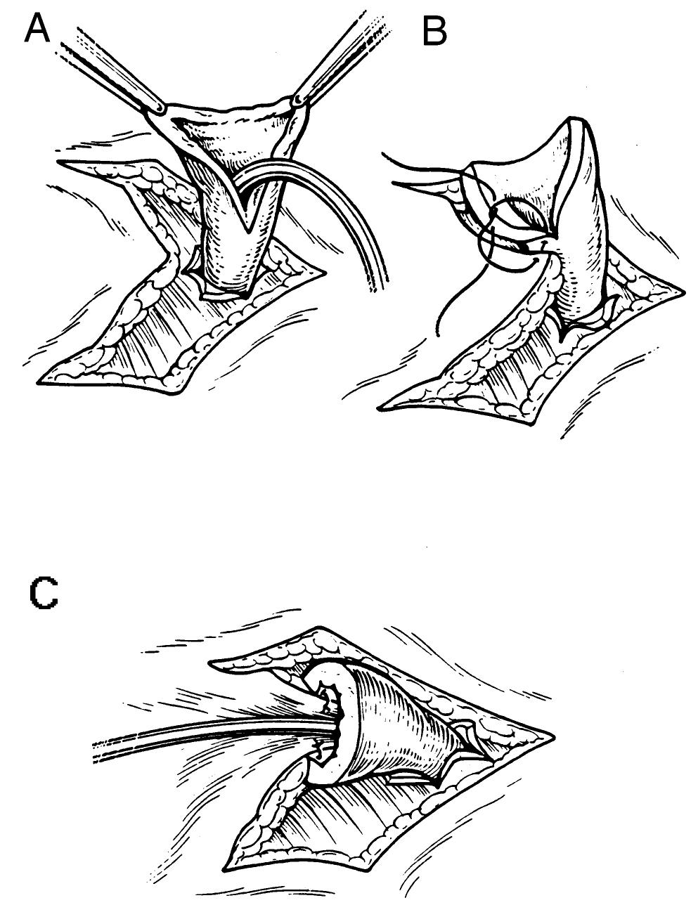 Stomal skin flap. (a) a chevron skin incision is made north