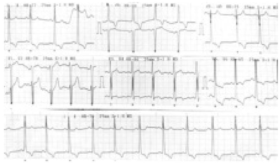 -1: ecg shows left ventricular hypertrophy with strain