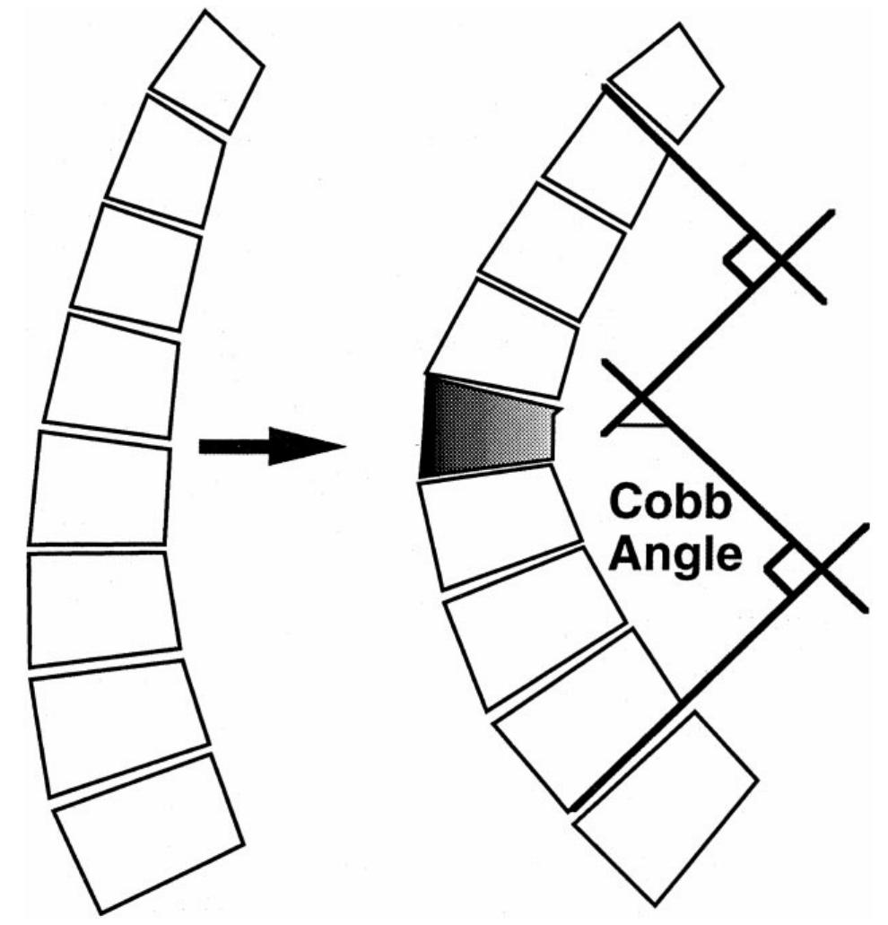 Illustration of anterior wedge deformity of thoracic
