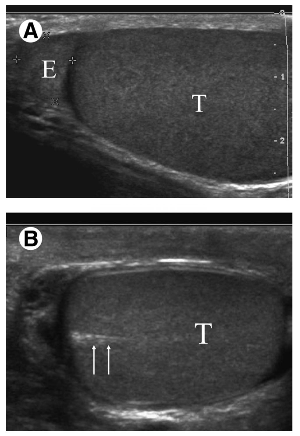 Normal testis and epididymis. (a) longitudinal and (b)