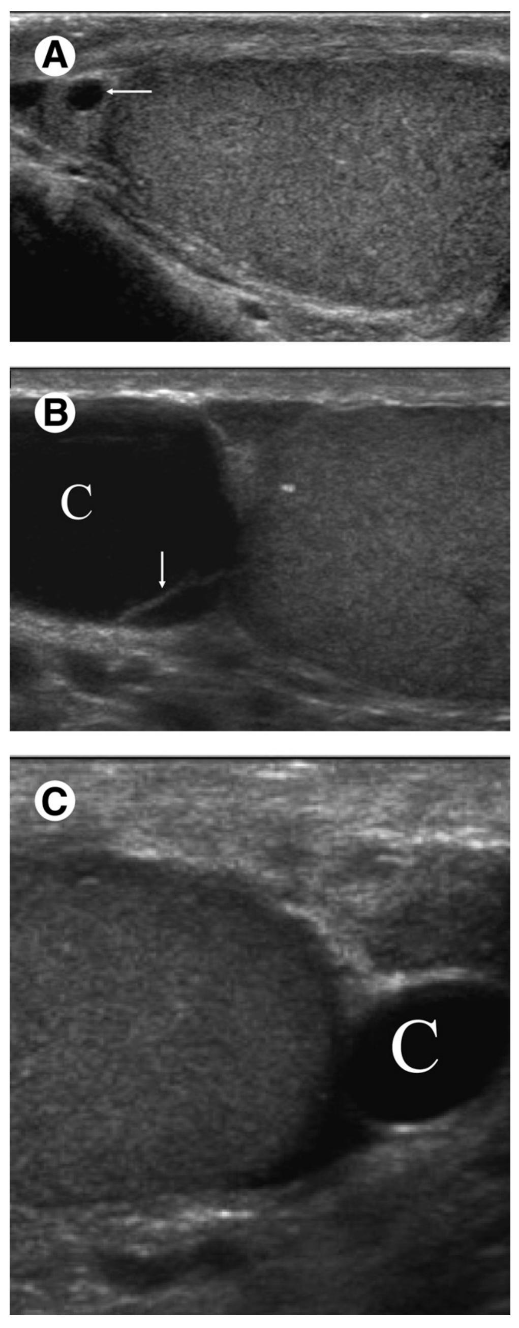 Epididymal cysts. longitudinal scans of the testis showing