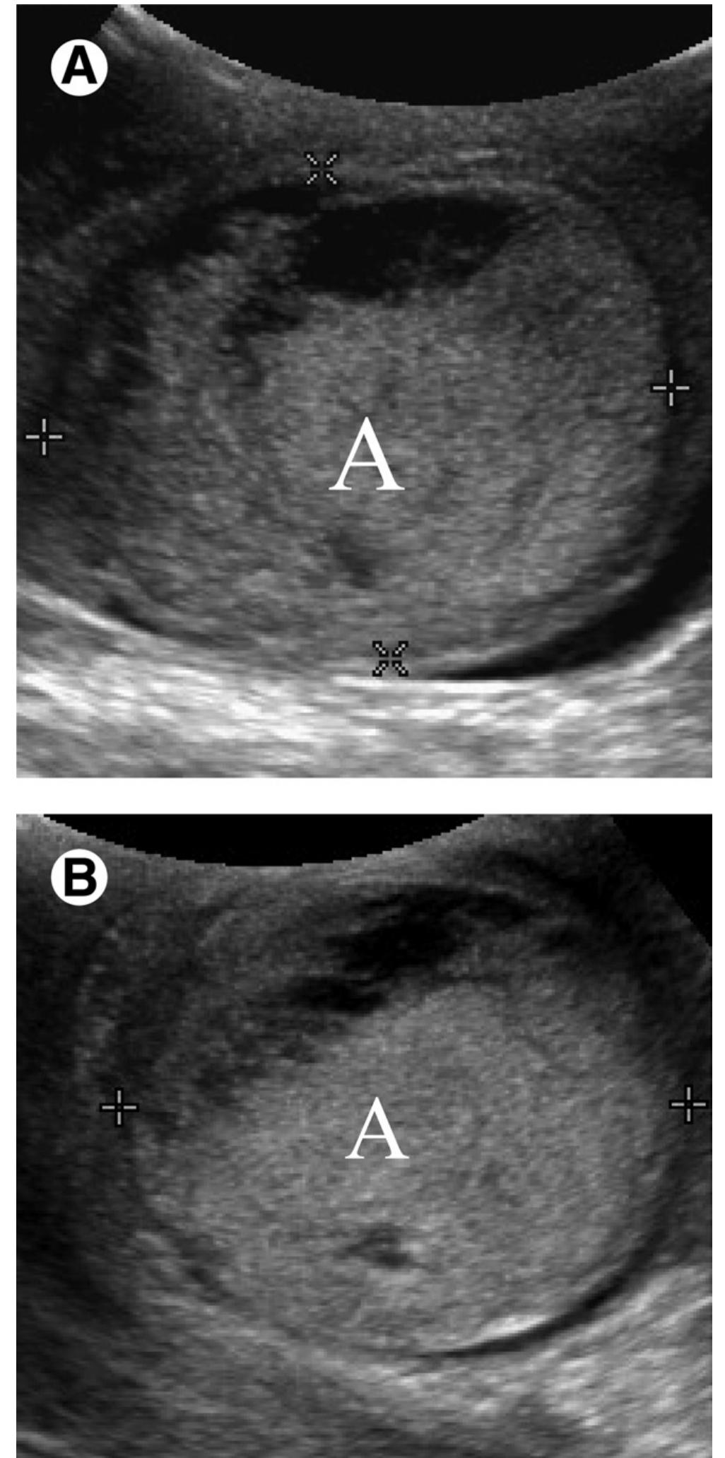 Testicular abscess. (a) longitudinal and (b) transverse