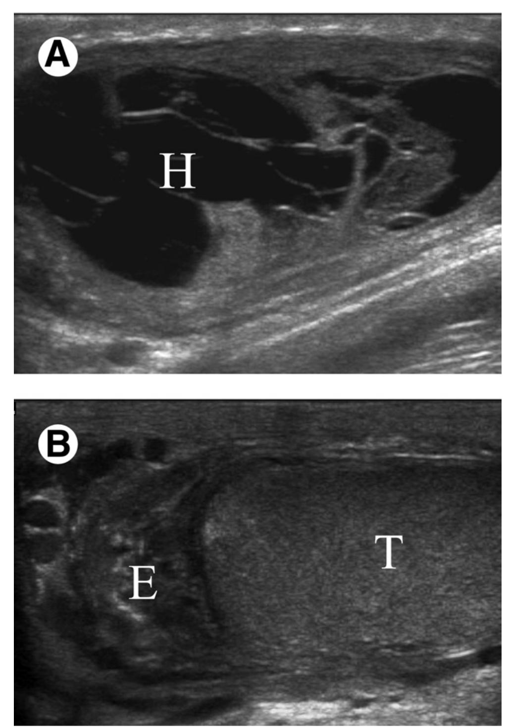 Complex hydrocele secondary to acute epididymitis. lon-
