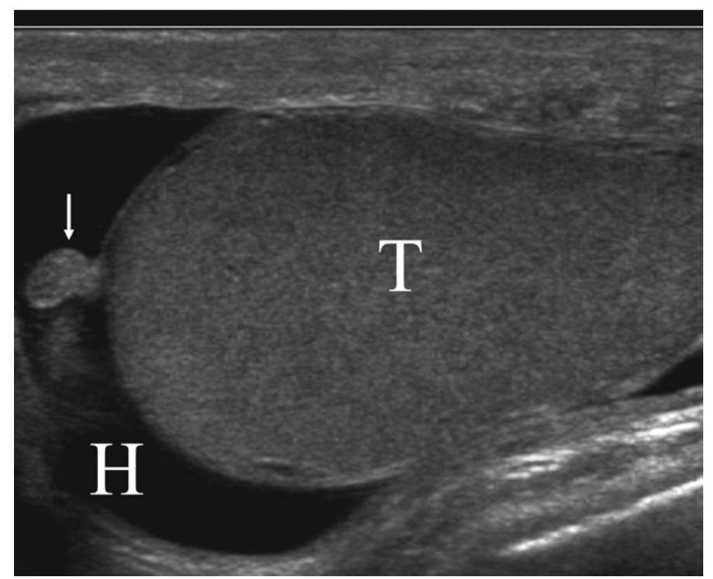 Appendix testis. longitudinal scan of the upper pole of the