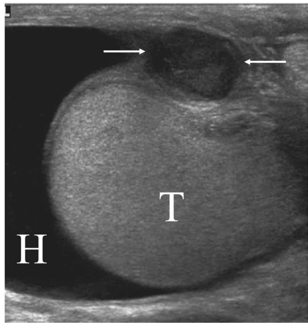 Acute epididymitis with a focal epididymal abscess. trans-