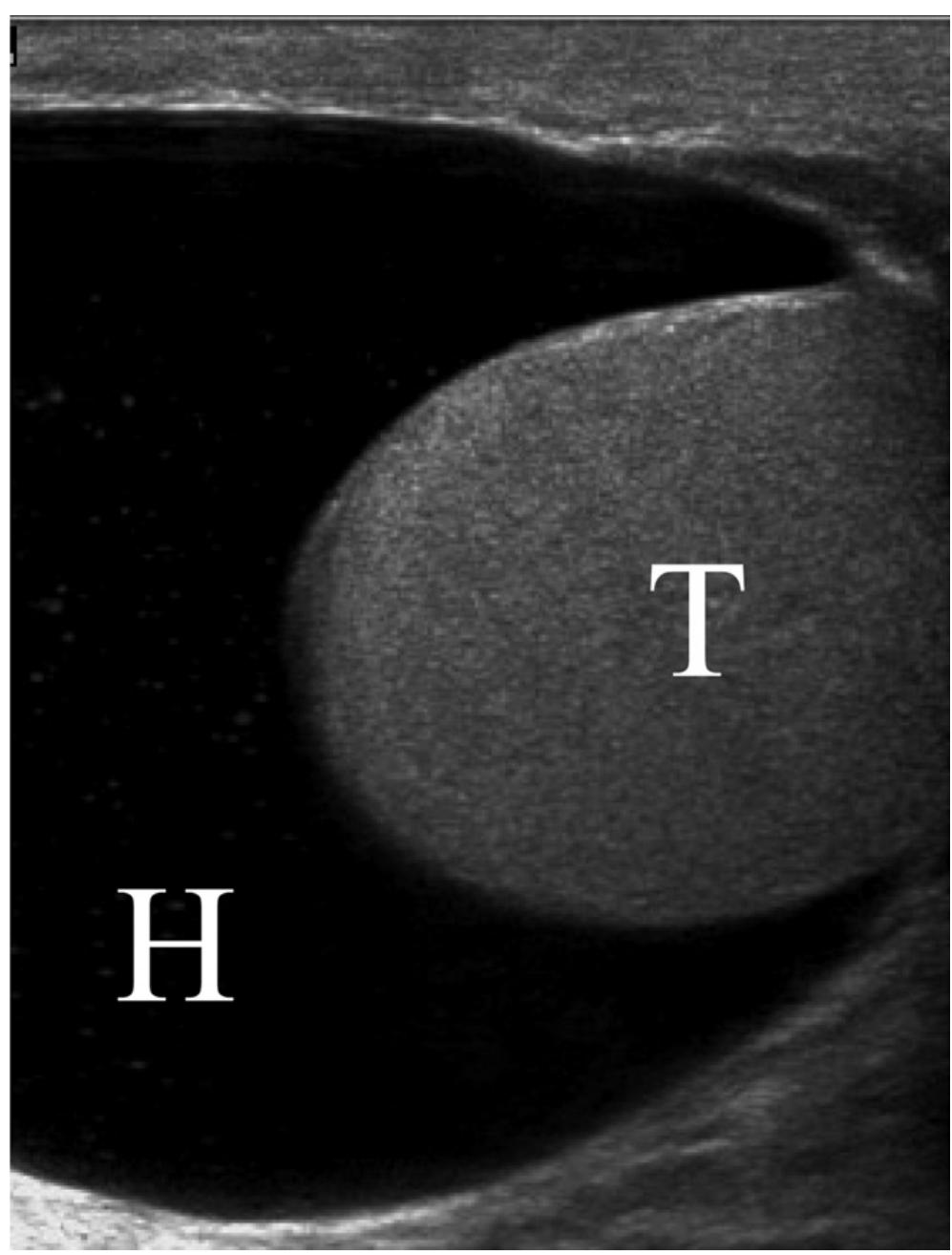 Simple hydrocele. transverse scan of a normal testis (t)
