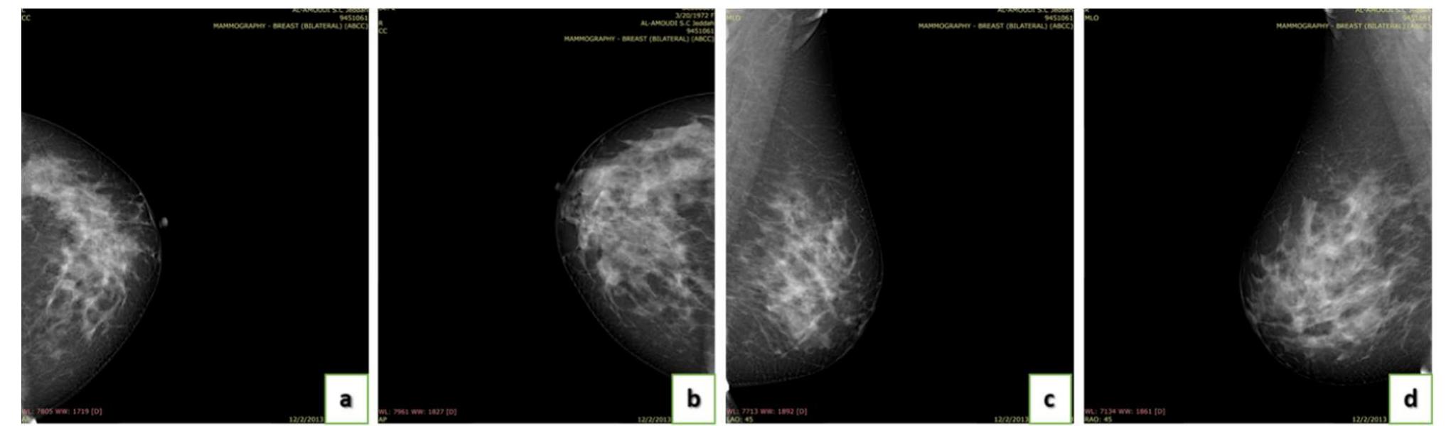 Some examples of bi-rads 0: (a) cc view of the left breast;
