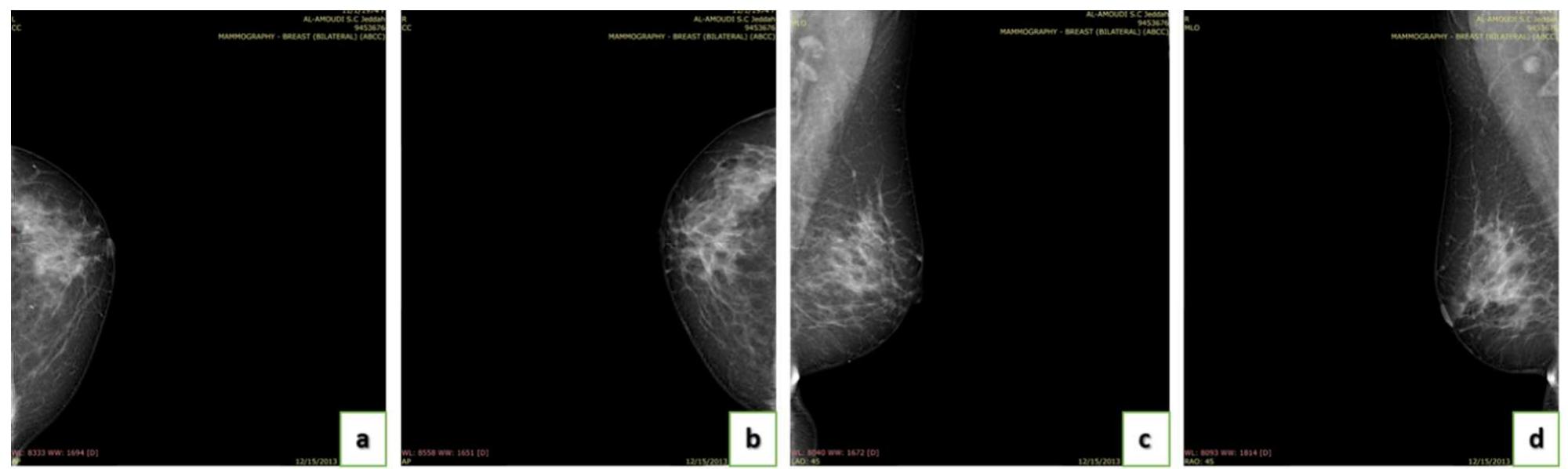 Some examples of bi-rads 1: (a) cc view of the left breast;