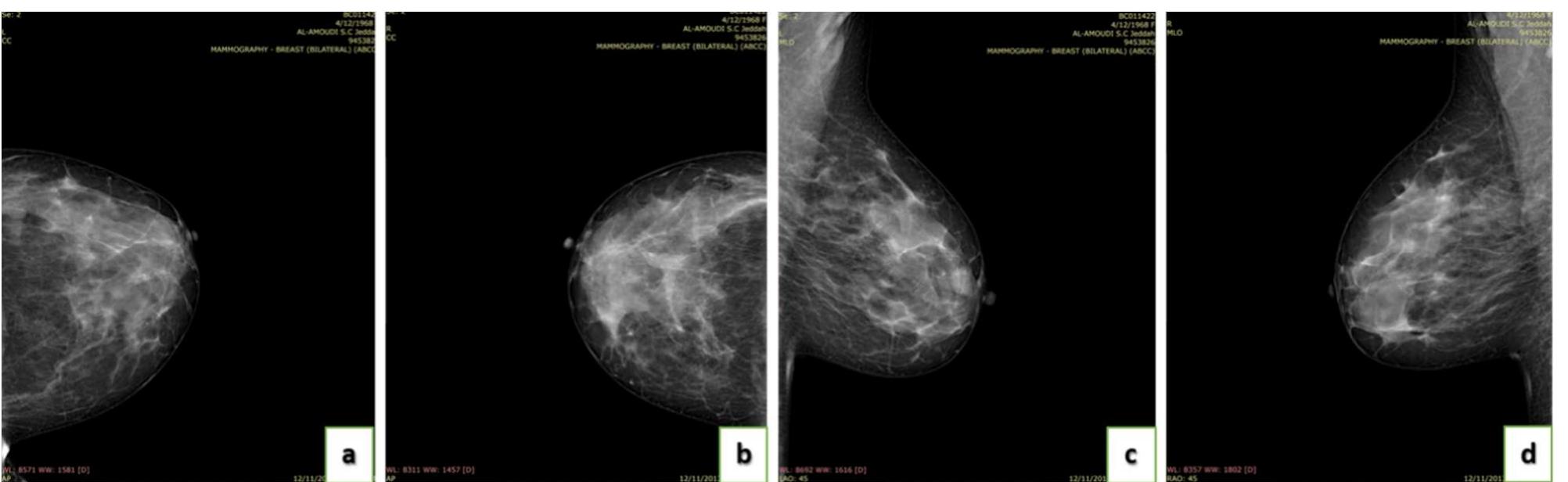 Some examples of bi-rads 2: (a) cc view of the left breast;