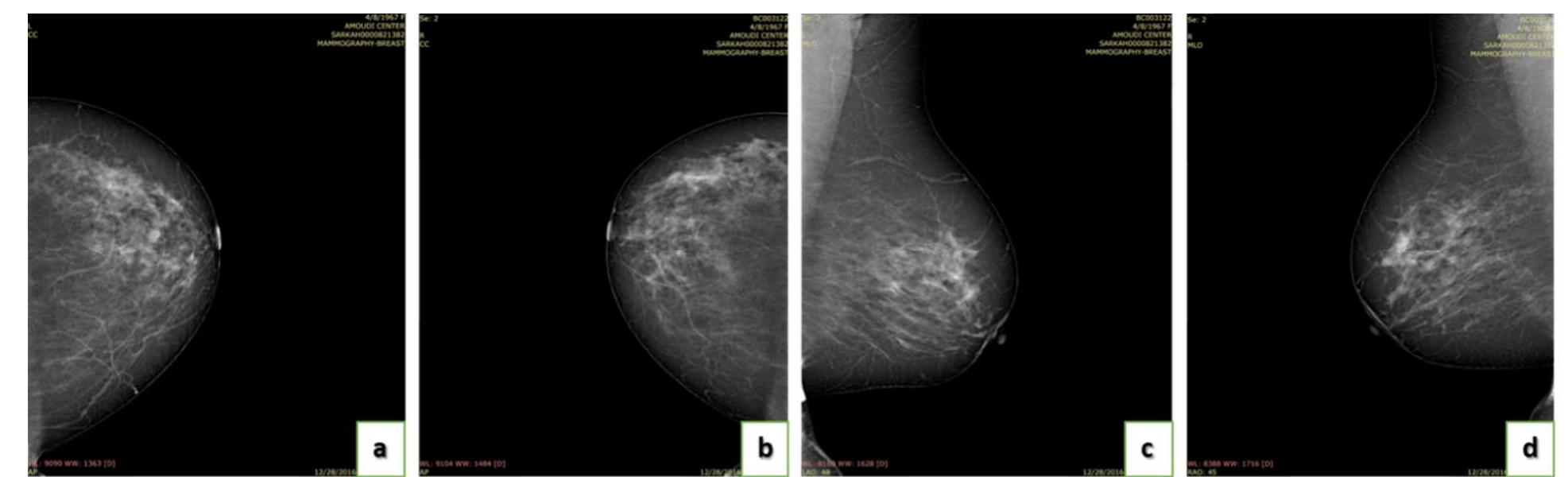 Some examples of bi-rads 3: (a) cc view of the left breast;