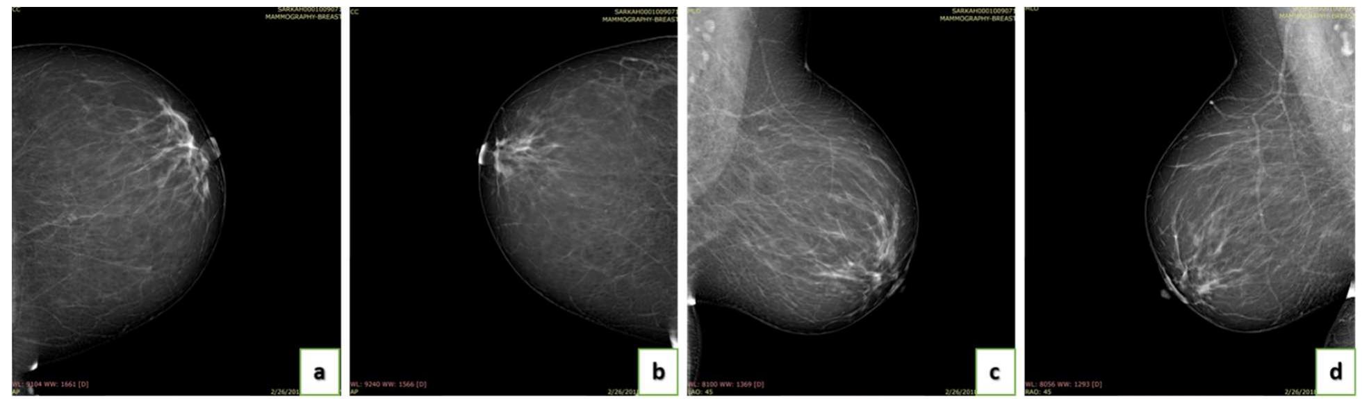 Some examples of bi-rads 4: (a) cc view of the left breast;