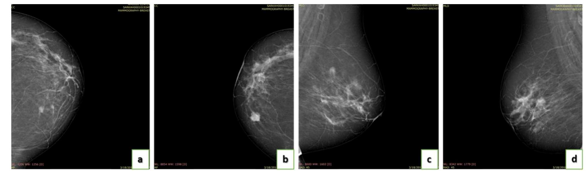 Some examples of bi-rads 5: (a) cc view of the left breast;