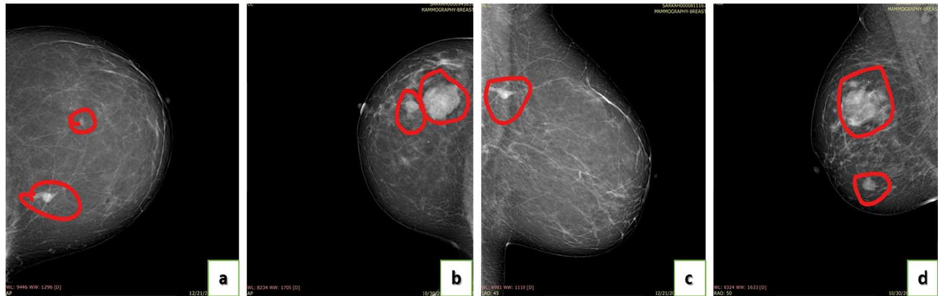 Examples of dataset annotation for bi-rads 4: (a) cc view of