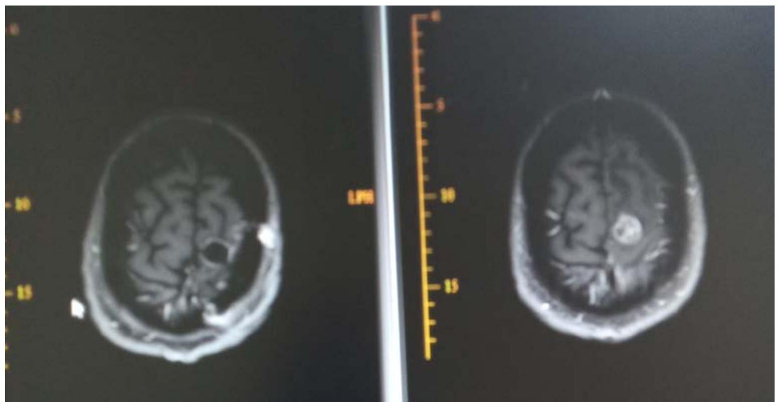 Shows the images of patient with left parietal metastasis
