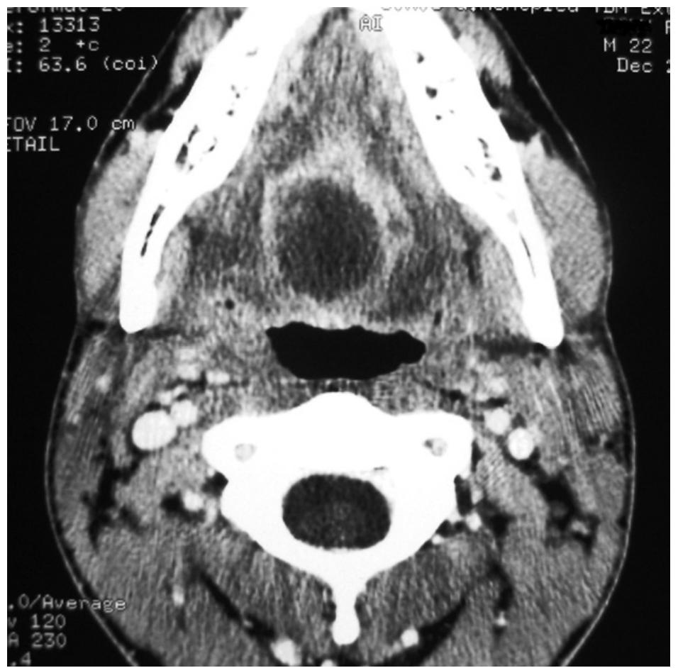 Axial enhanced ct scan showing an acute abscess of the base