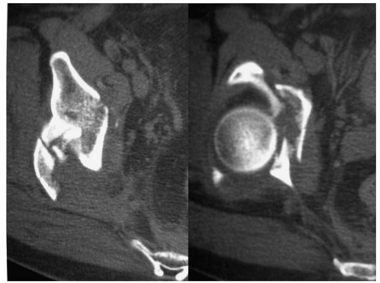 Acetabular fracture: axial ct image shows the dislocation of