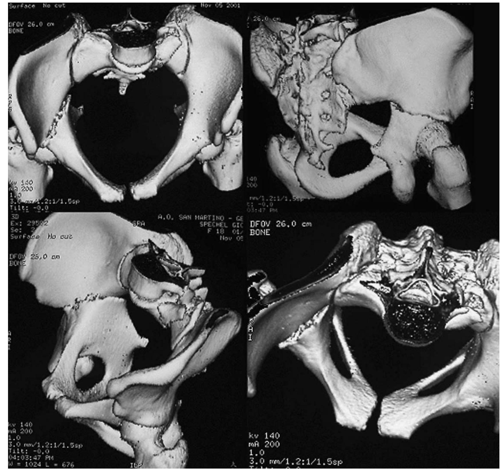 3d reconstruction of the left hemisacrum fracture and right