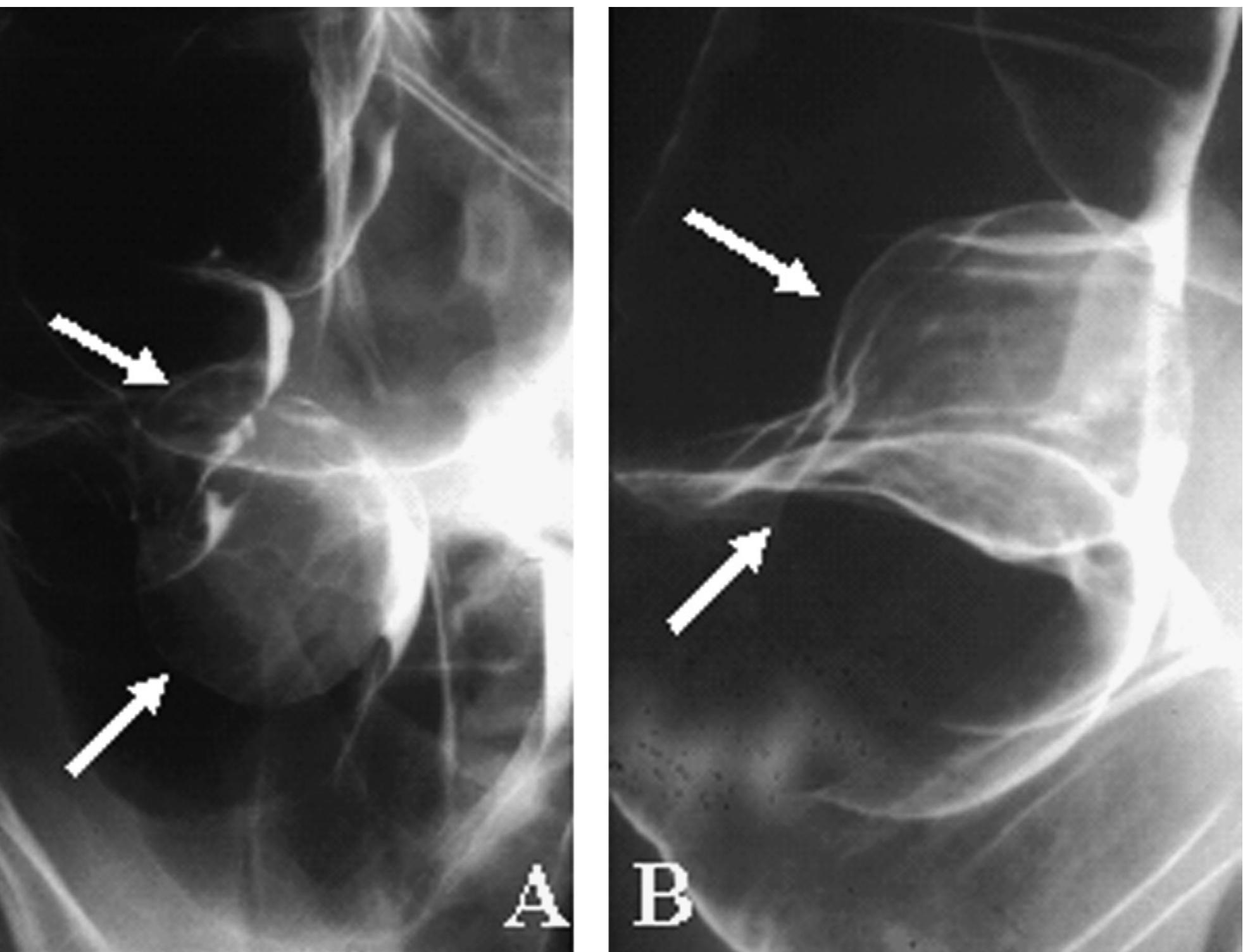 a B Two Examples Of Lipoma Of The Ascending Colon a B Two Examples Of Lipoma Of The Ascending Colon