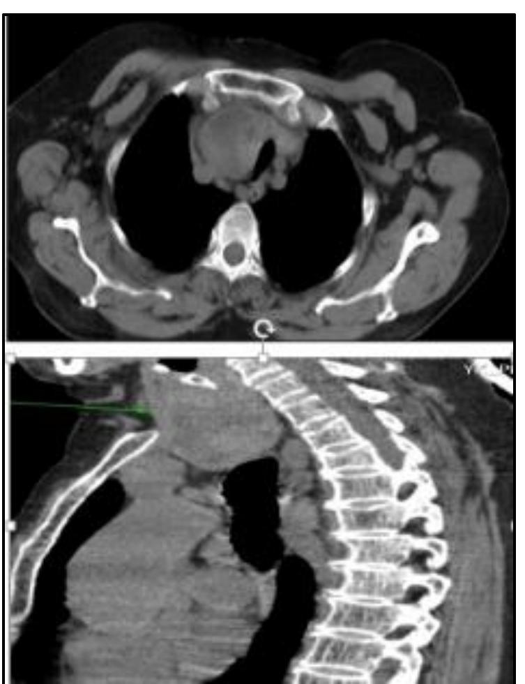 Ct images (axial and sagittal) shows well defined solid
