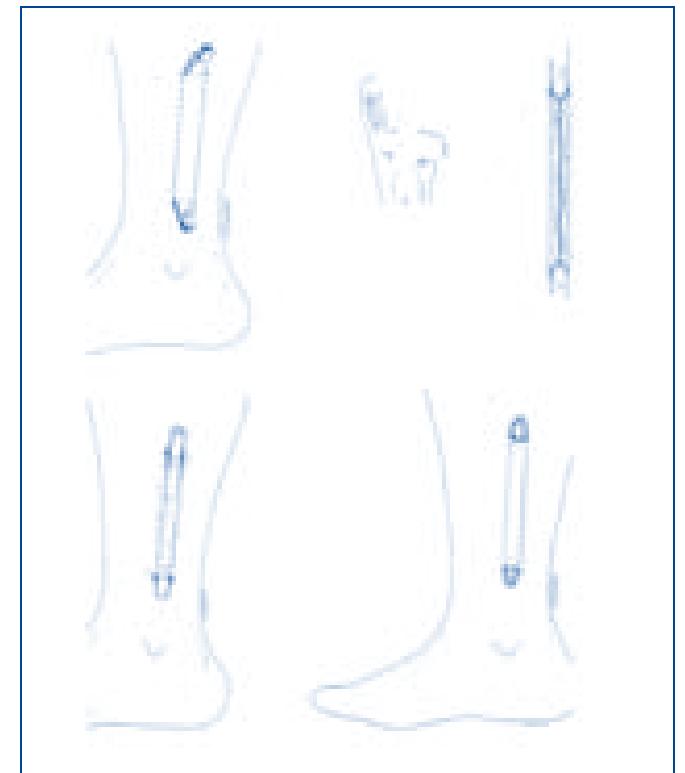 Figure 9 - Vascularized bone of the fibula and iliac crest