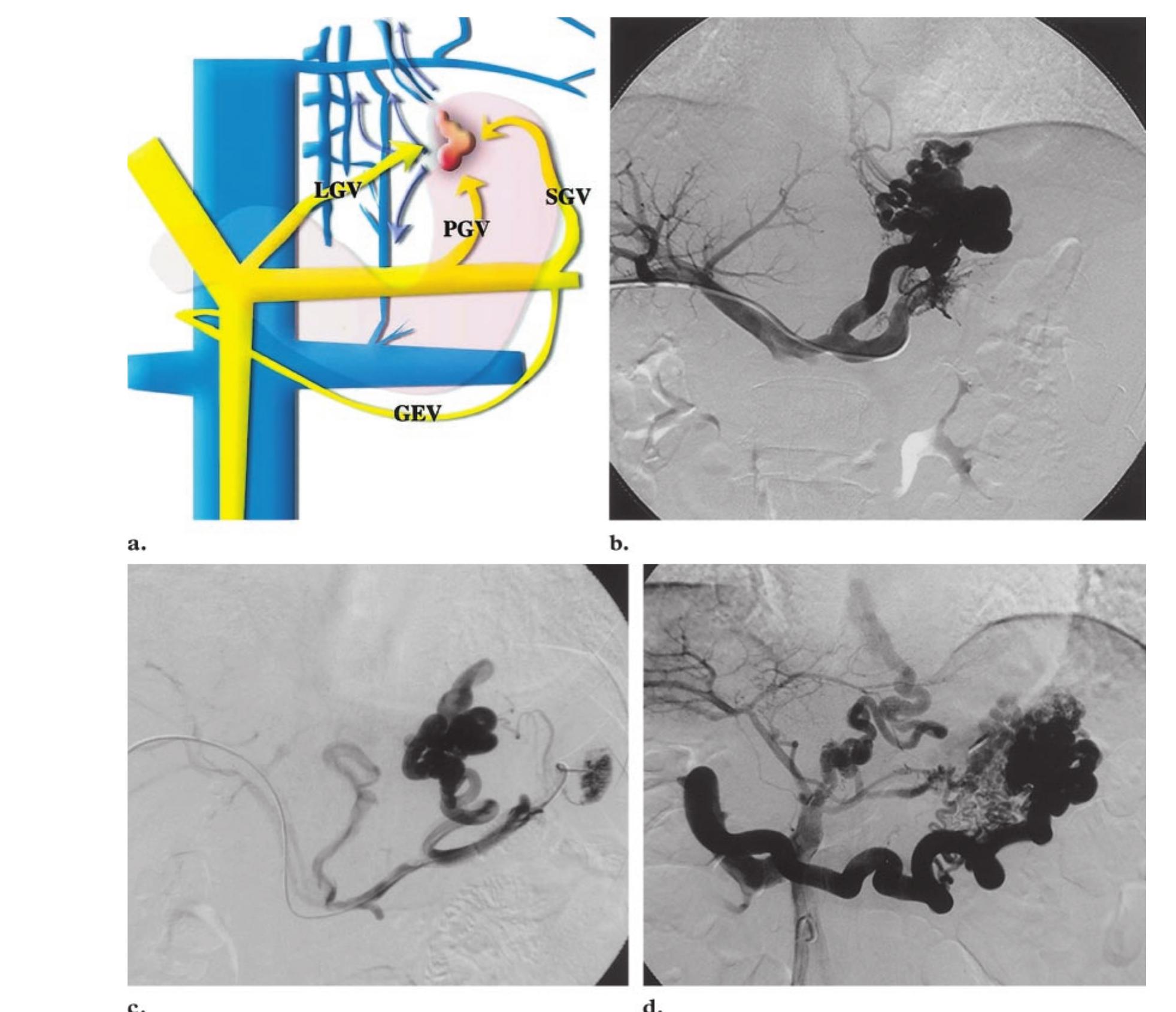 (a) drawing illustrates the afferent gastric veins, any of