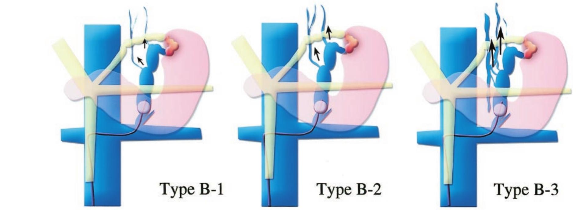 Drawings illustrate the three subtypes of type b gastric