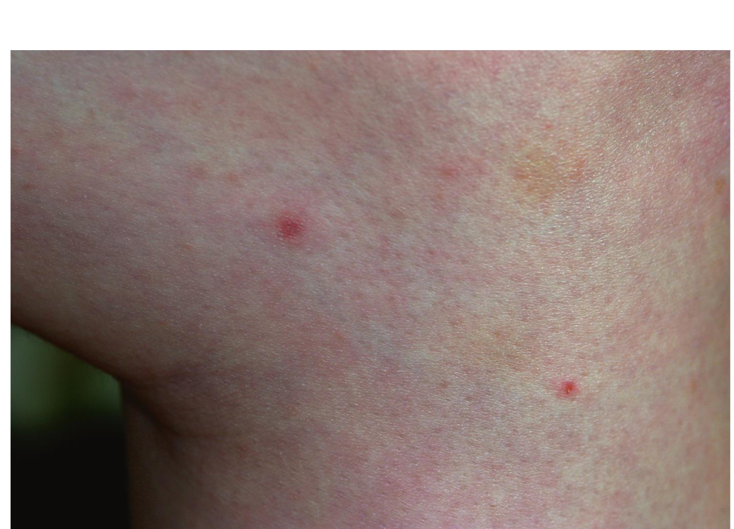 Figure 2 - from Ectoparasites from Feral Pigeons Affecting