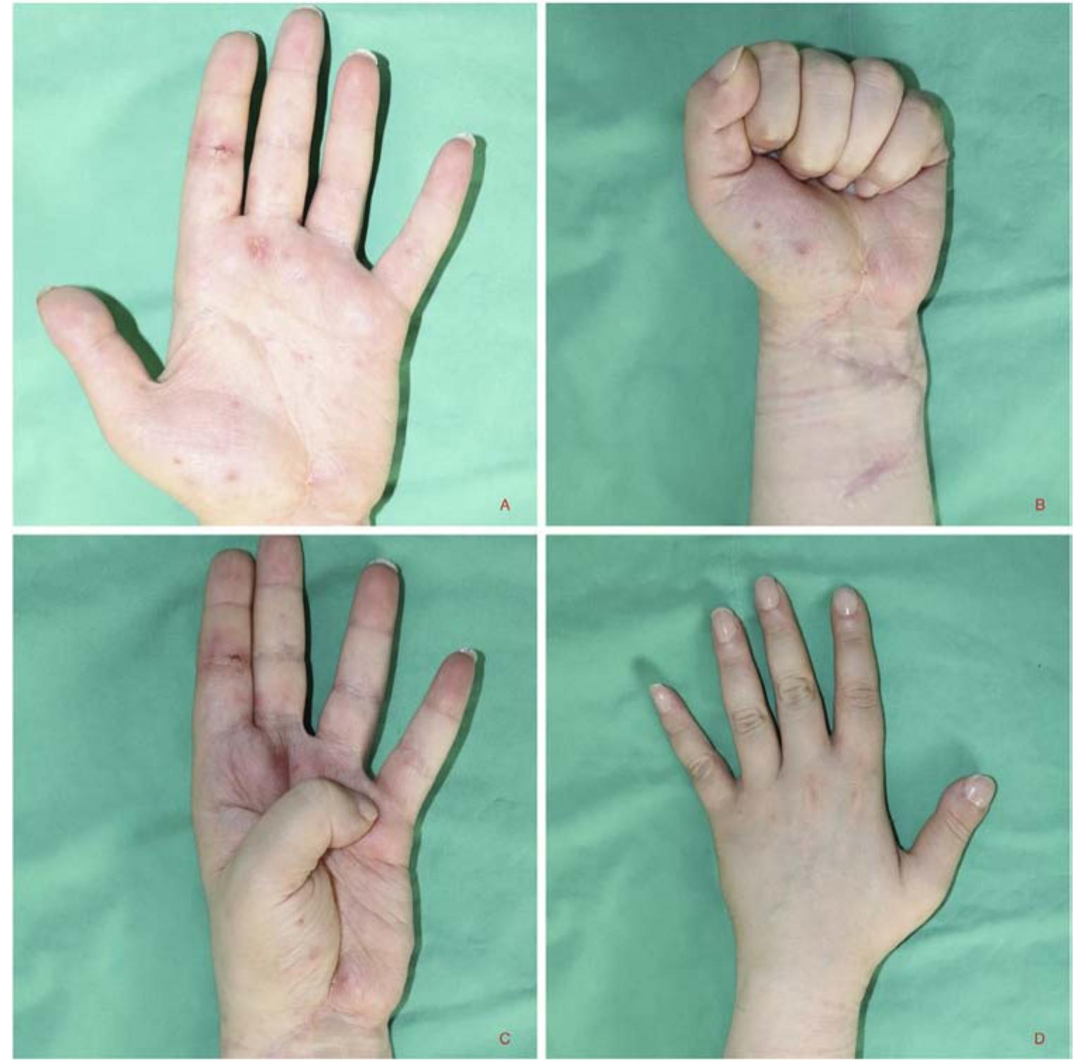 Postoperative images. wartenberg sign present 12 months