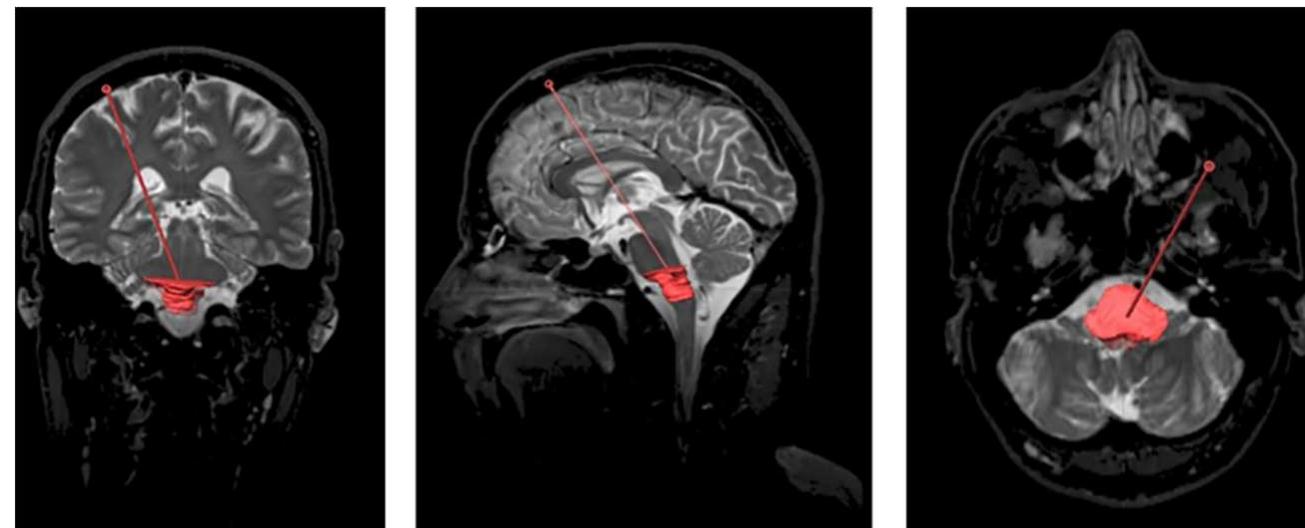 Stereotactic biopsies of brainstem lesions play an impor-